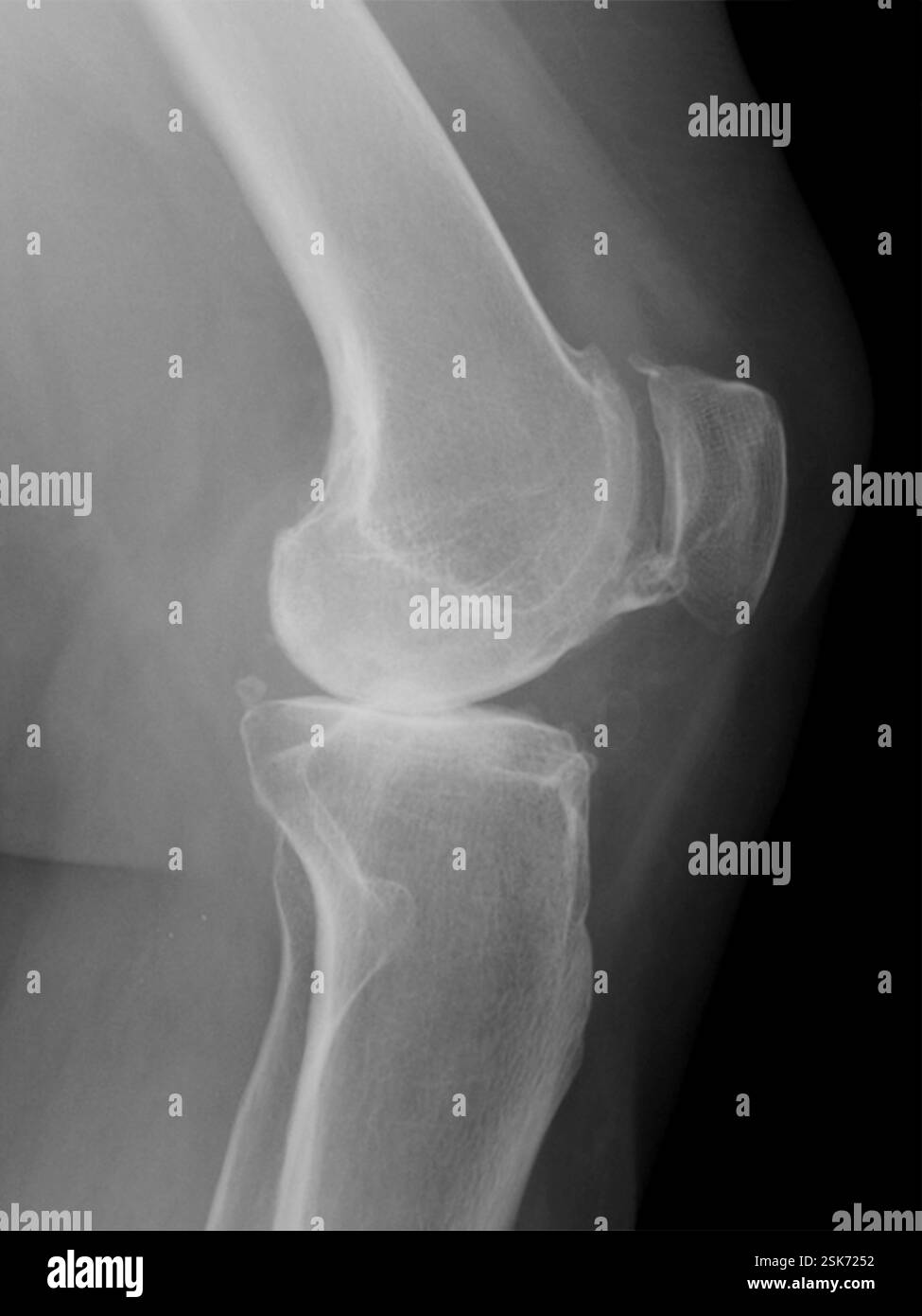 X-ray of a side view of the left knee of a 70 year old male patient ...
