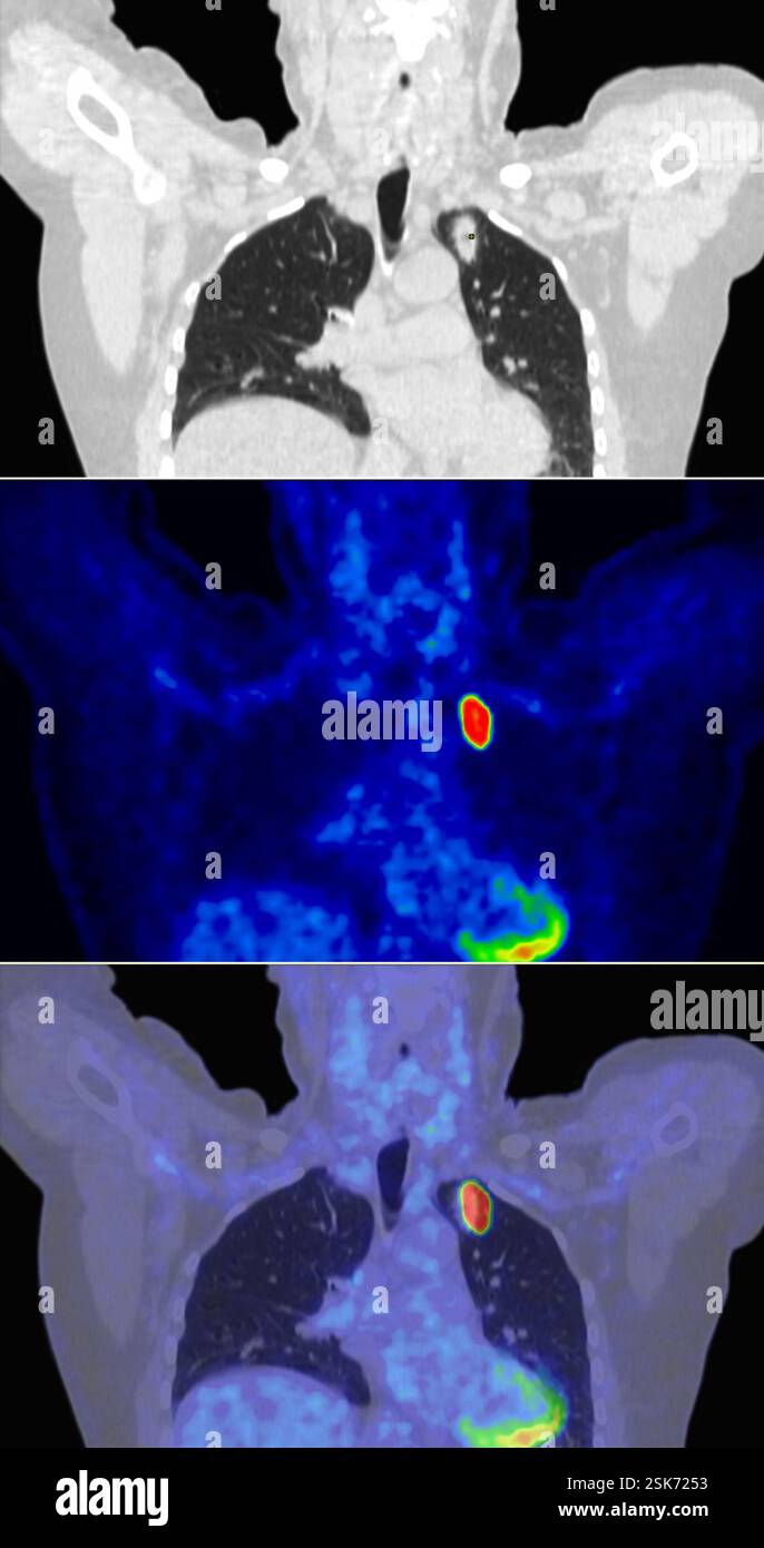 Computed tomography (CT, top) and coloured positron emission tomography (PET, centre) scans in ...