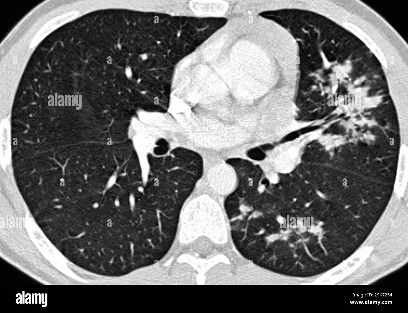 Hodgkin's lymphoma. Computed tomography (CT) scan of a 22 year old male ...