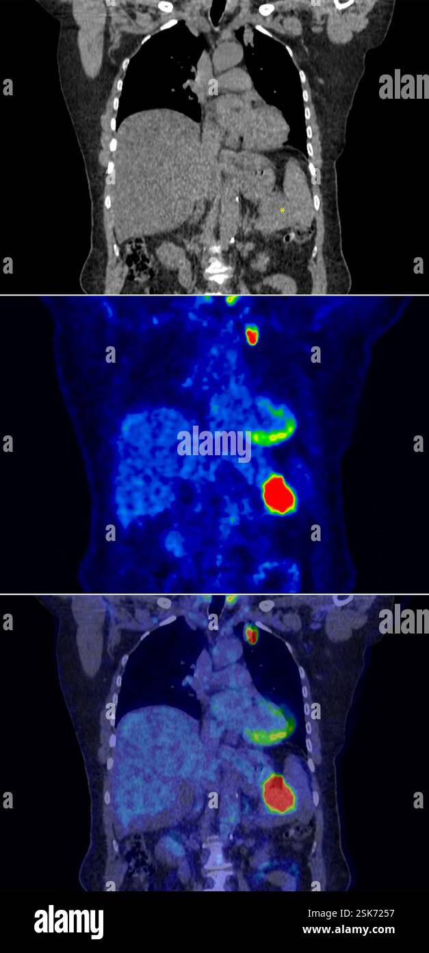 Pancreatic cancer, computed tomography (CT) and positron emitted tomography (PET) scan of the ...