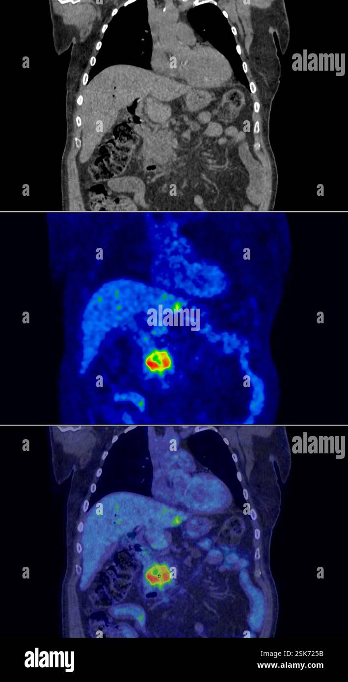 Computed tomography (CT, top) and coloured positron emission tomography (PET, centre) scans in ...