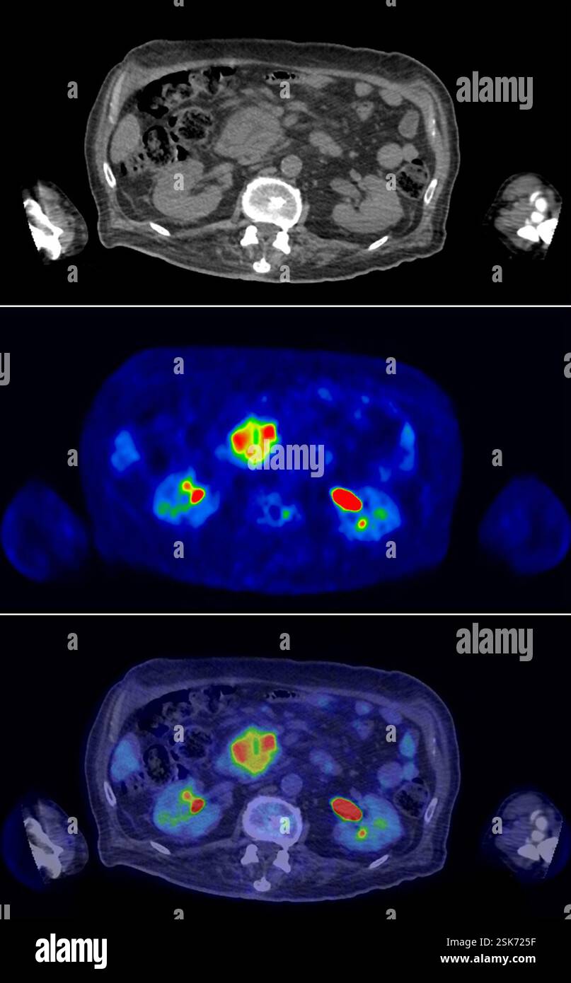 Computed tomography (CT, top) and coloured positron emission tomography (PET, centre) scans in ...