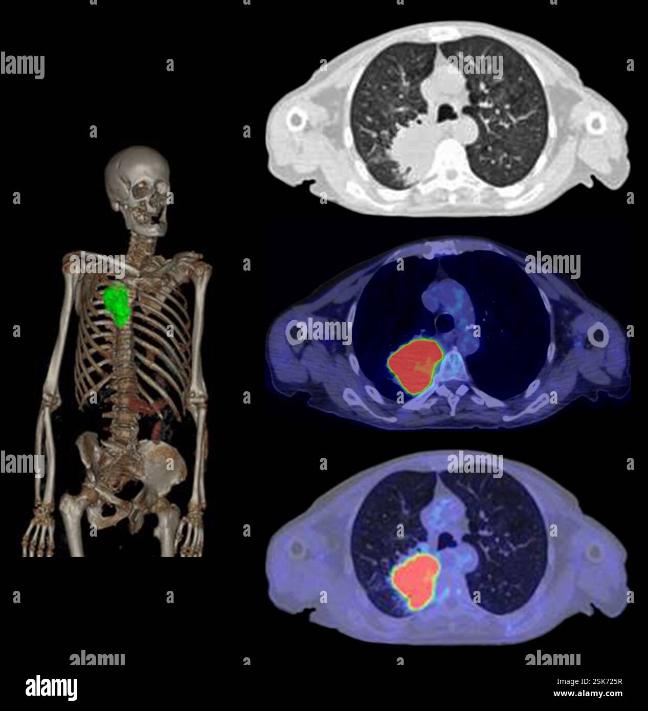 Erythrodermic psoriasis on a man's legs Stock Photo - Alamy