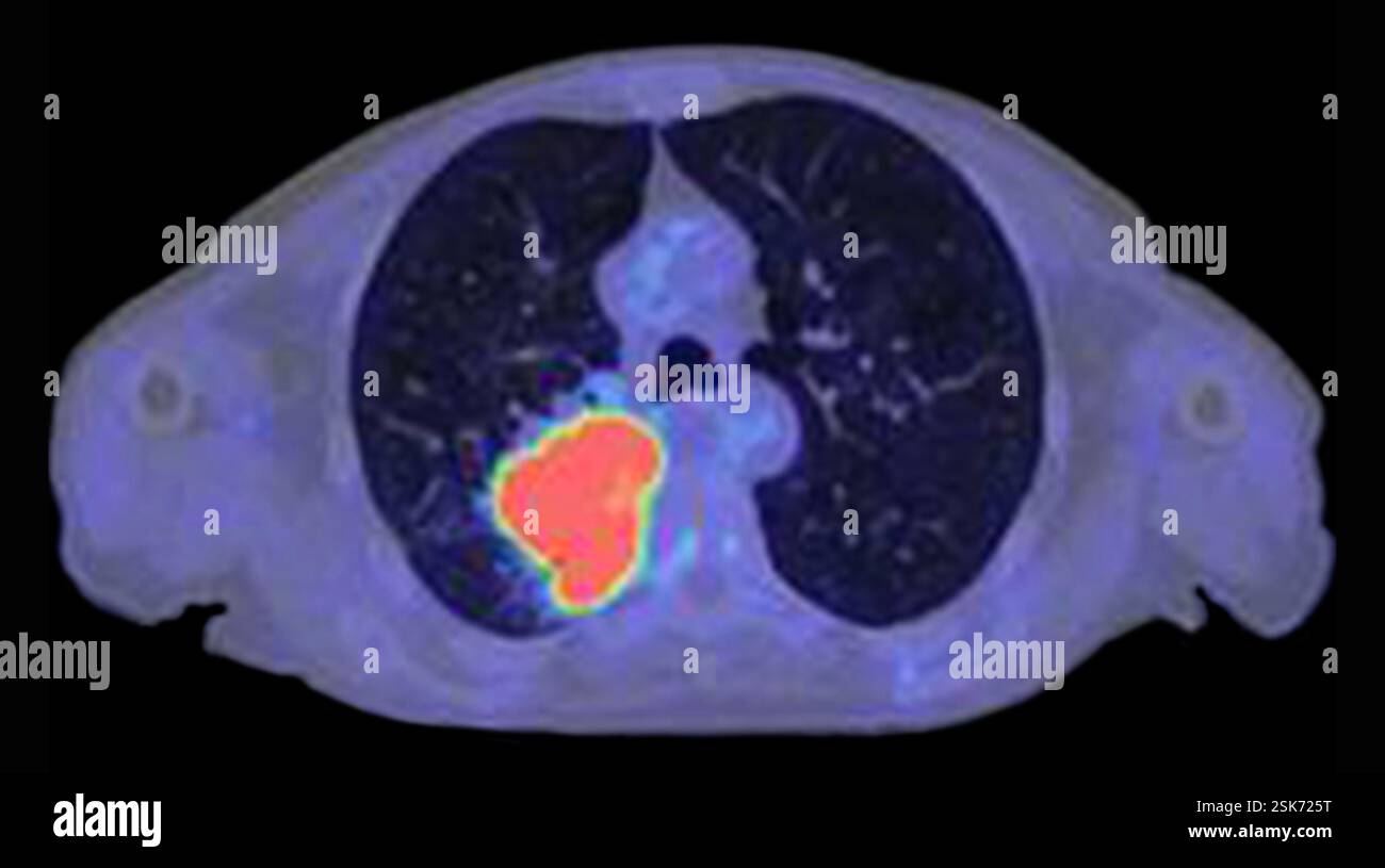 Combined coloured computed tomography (CT) and positron emission tomography (PET) scans in ...