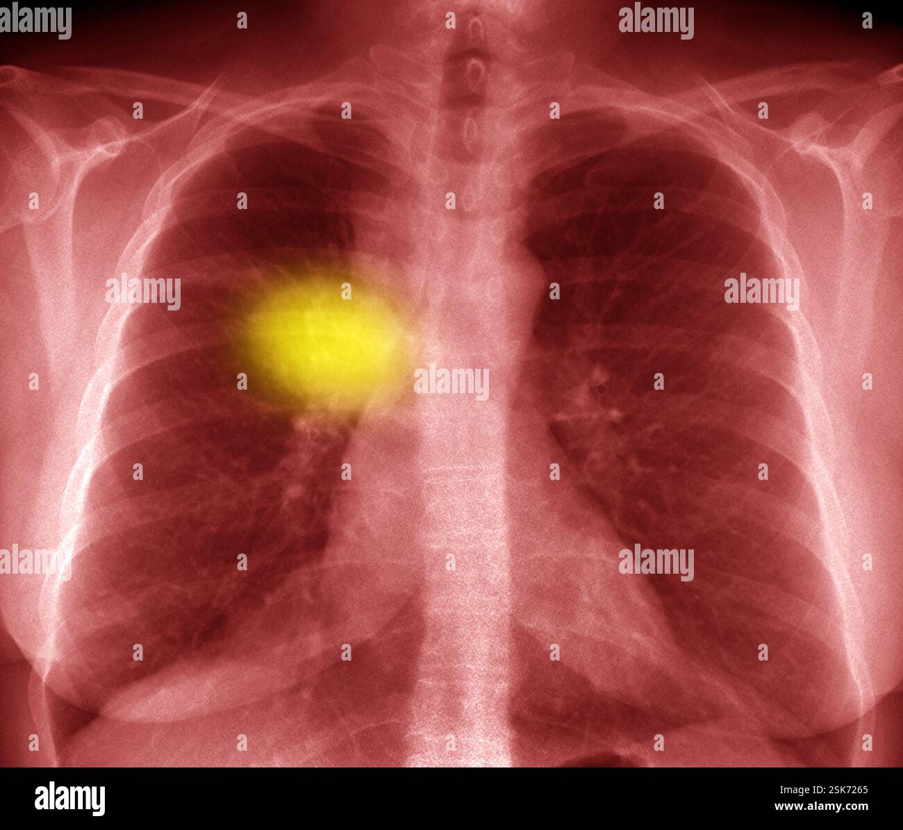Lung cancer, X-ray. Frontal view of a coloured chest X-ray of a 62-year ...