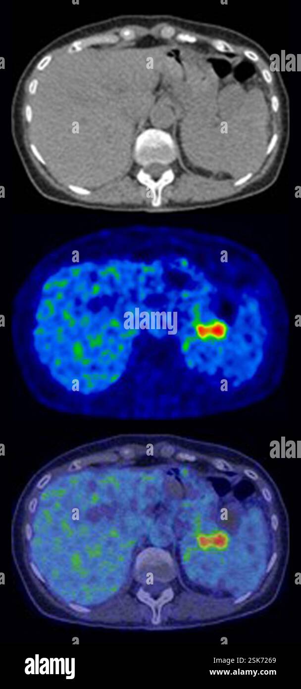 Computed tomography (CT, top) and coloured positron emission tomography (PET, centre) scans in ...