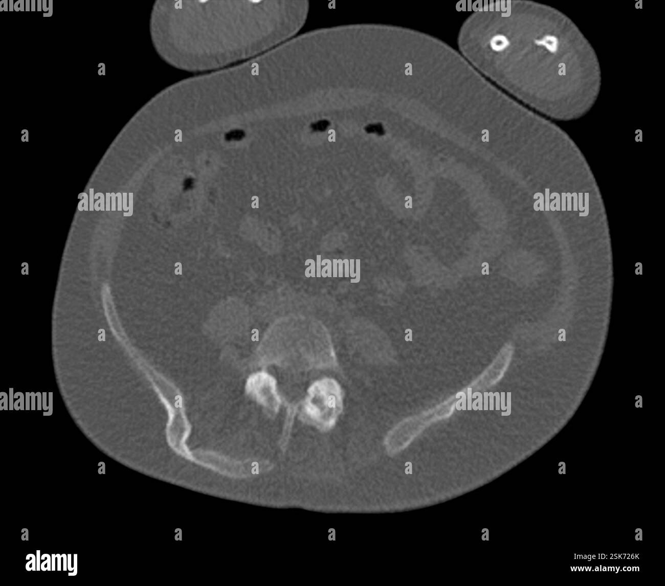 Computed tomography (CT) scan of the abdomen a 36 year old female ...