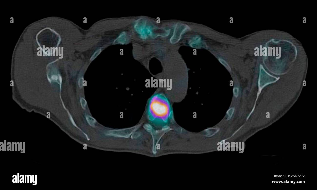Secondary bone cancer in the vertebra. Coloured composite image of a ...