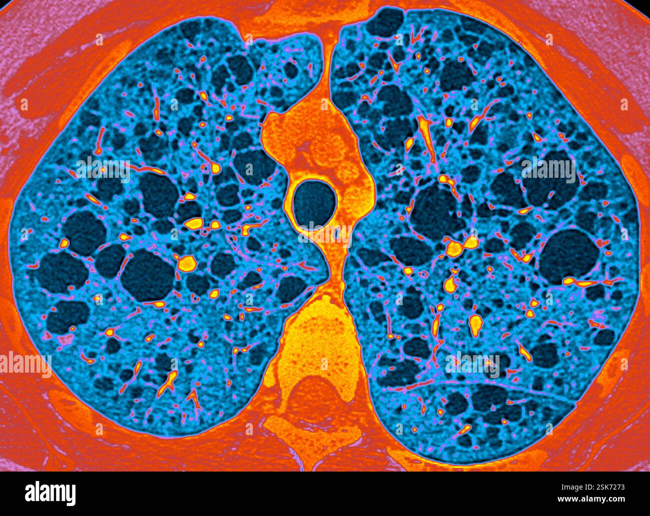 Coloured computed tomography (CT) scan of pulmonary ...