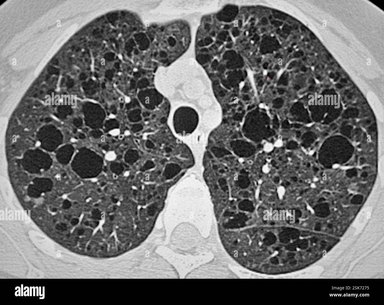 Computed tomography (CT) scan of pulmonary lymphangioleiomyomatosis of ...