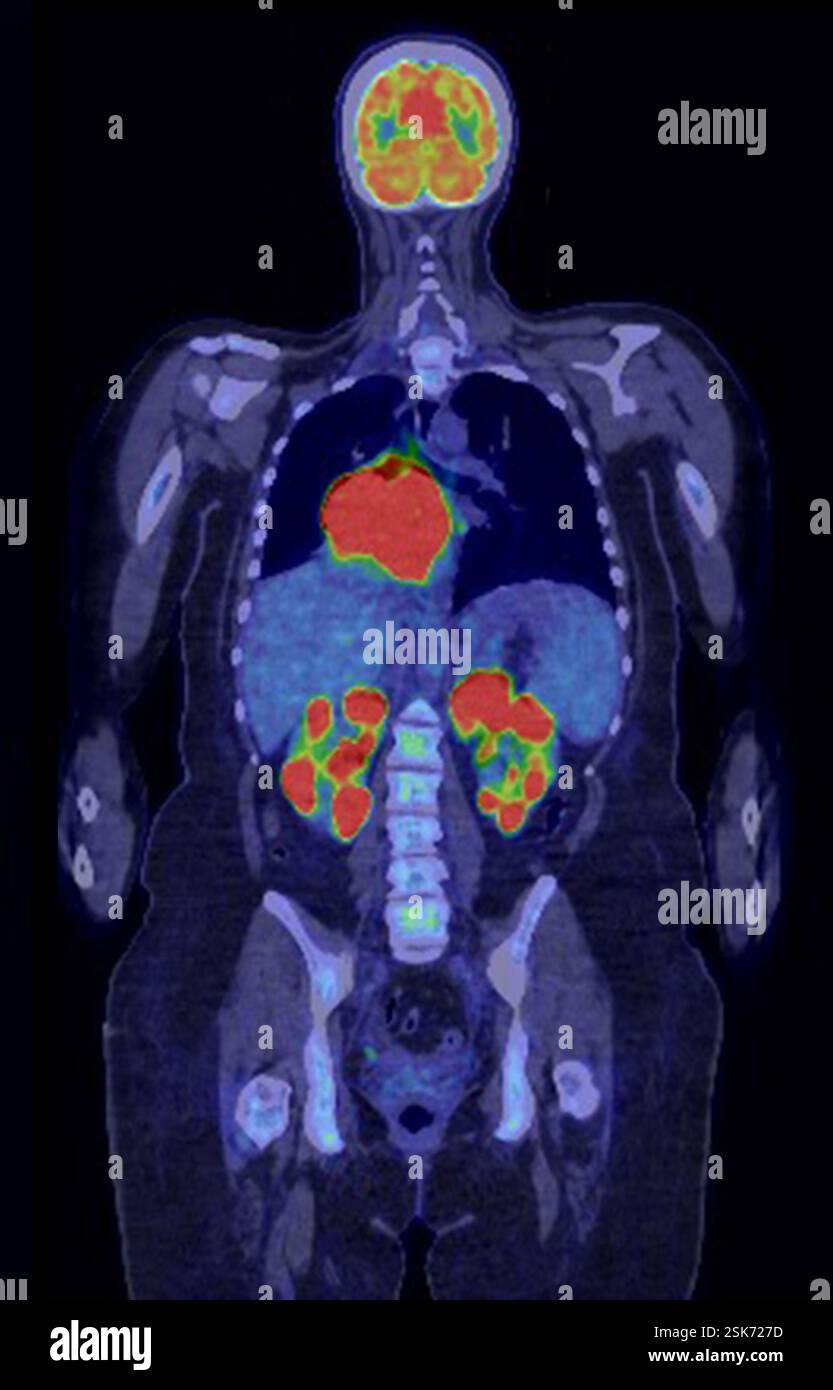 Drug eruptions on a woman's back Stock Photo - Alamy
