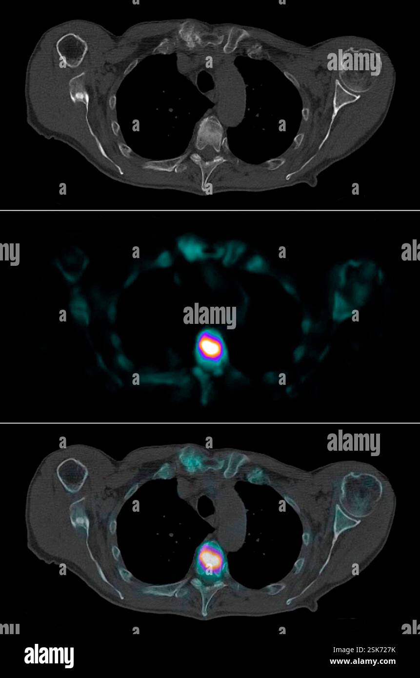 Secondary bone cancer in the vertebra. Computed tomography (CT, top ...