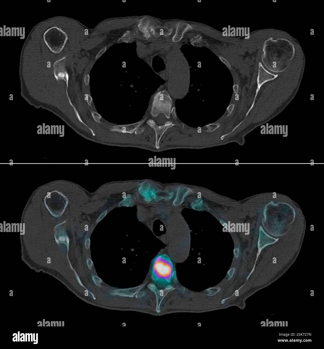 Secondary bone cancer in the vertebra. Computed tomography (CT, top ...