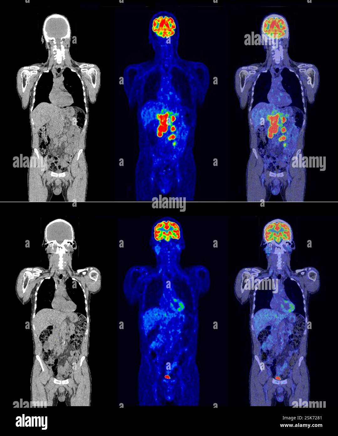 Drug eruptions on a woman's chest and abdomen Stock Photo - Alamy