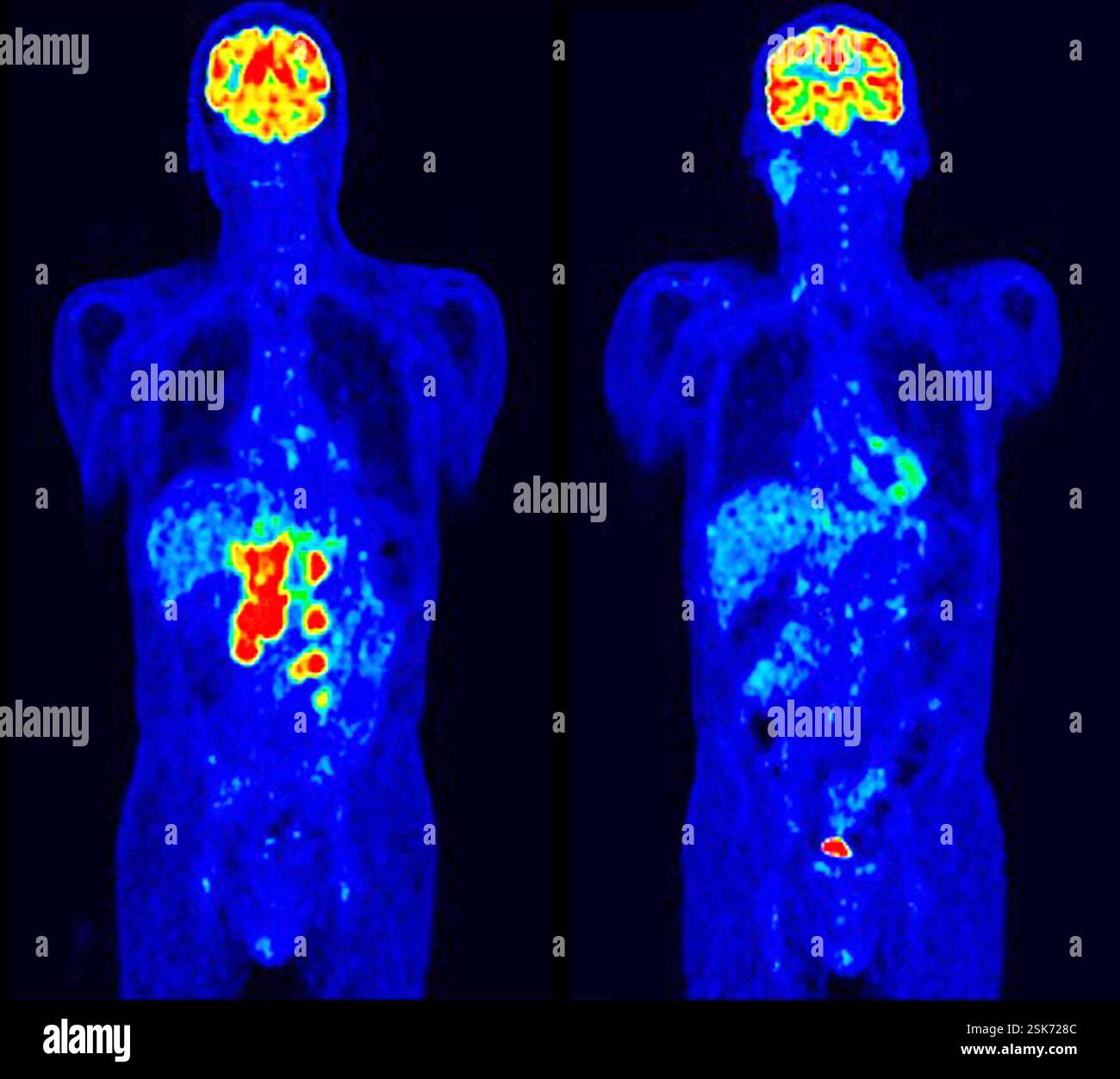 Positron-emission tomography (PET) scans of a coronal section through a ...