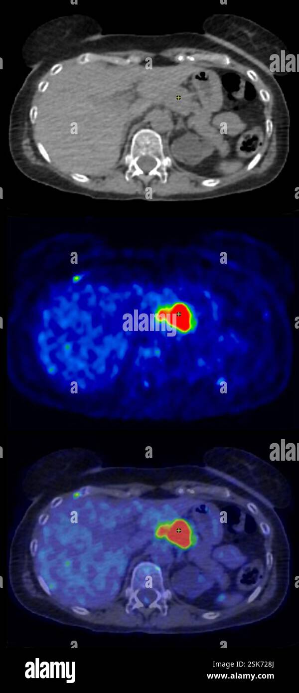 Clear cell adenocarcinoma to thyroid gland, light micrograph Stock ...