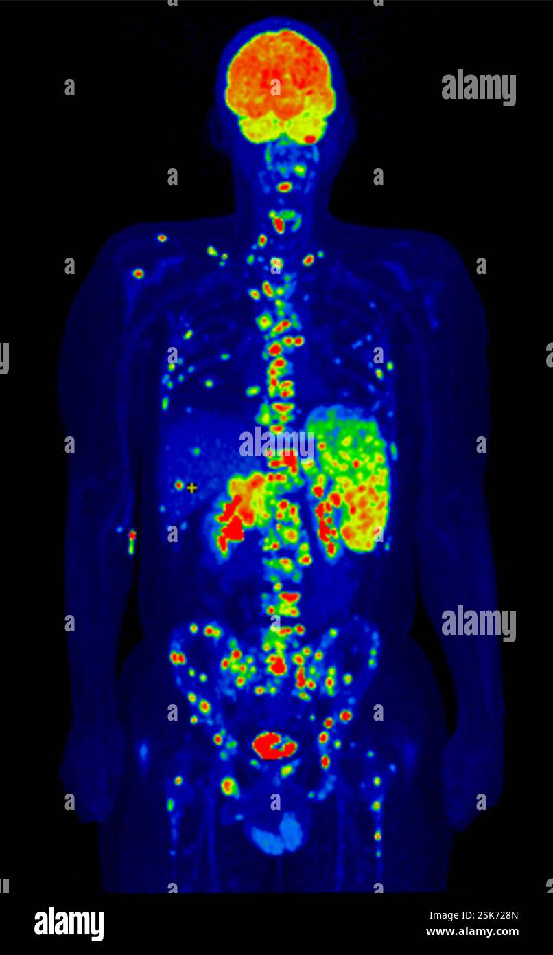 Keloid scars on a woman's ear Stock Photo - Alamy