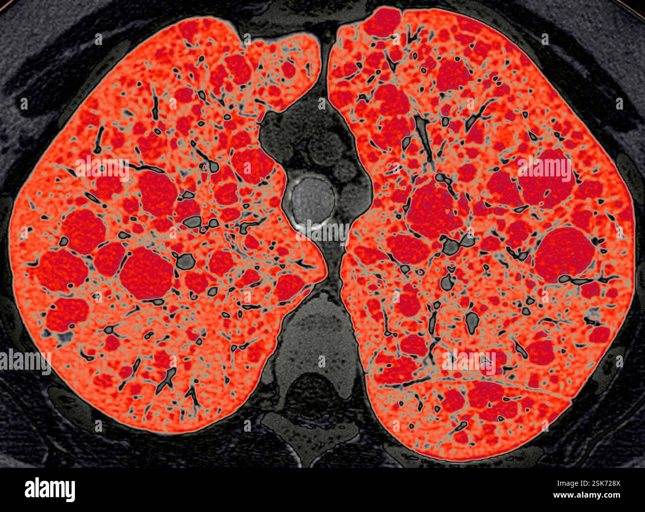 Coloured computed tomography (CT) scan of pulmonary ...