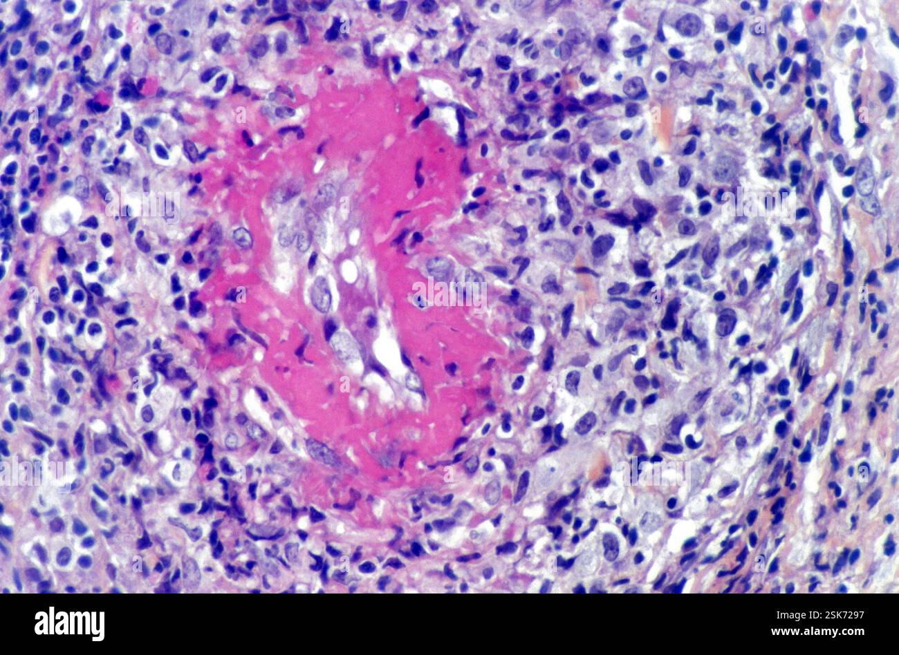 Light micrograph of a section of skin showing polyarteritis nodosa (PAN ...