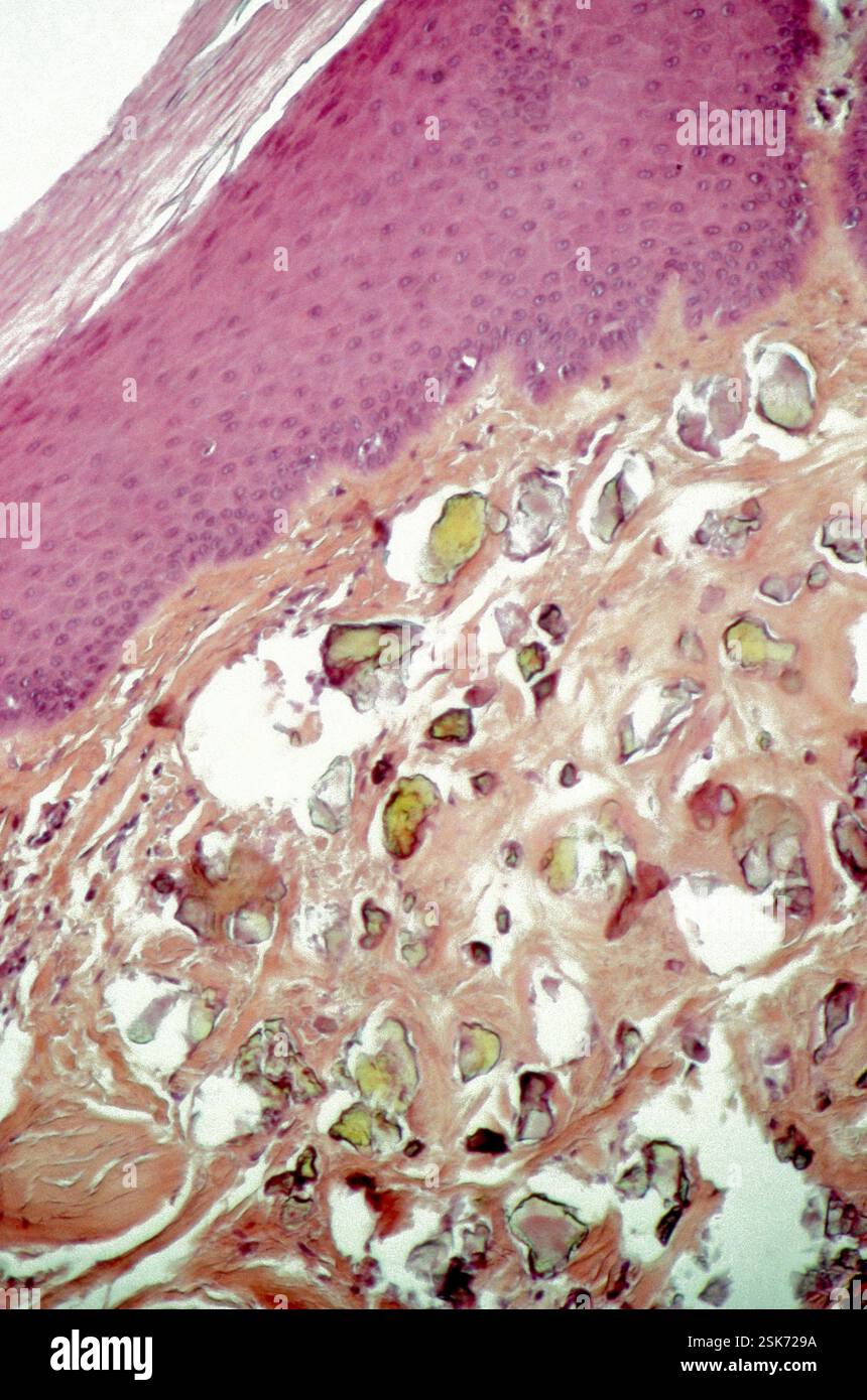 Light micrograph of a section of skin showing subcutaneous calcinosis ...