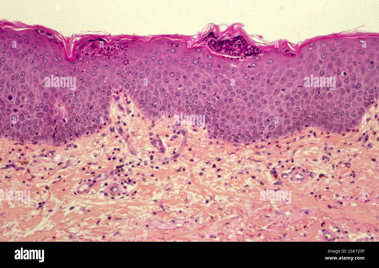 Light micrograph of a section through skin affected by psoriasis, a ...