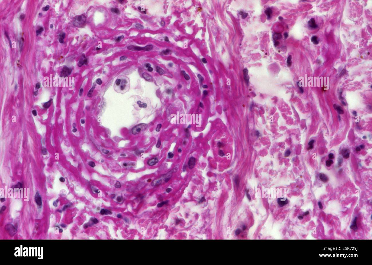 Light micrograph of a section of skin showing rheumatoid purpura, a ...