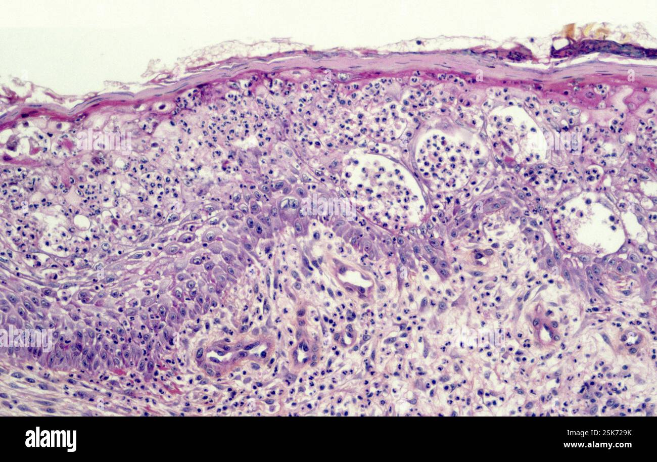 Light micrograph of a section of skin affected by Sweet's Syndrome ...