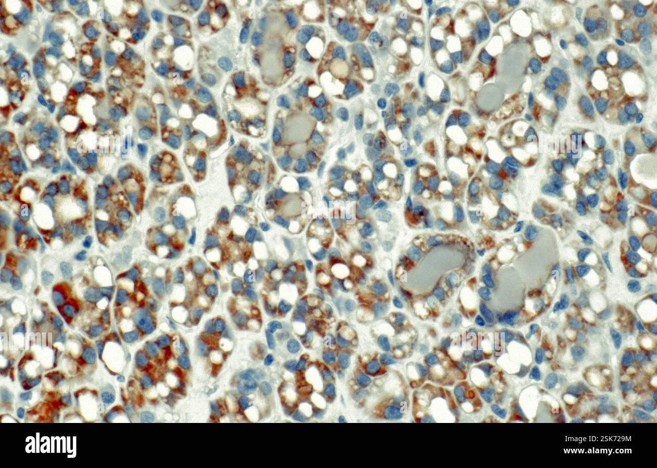 Light micrograph of a section of thyroid tissue affected by signet ring ...