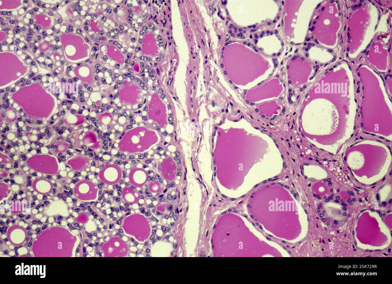 Light micrograph of a section of thyroid tissue affected by signet ring ...