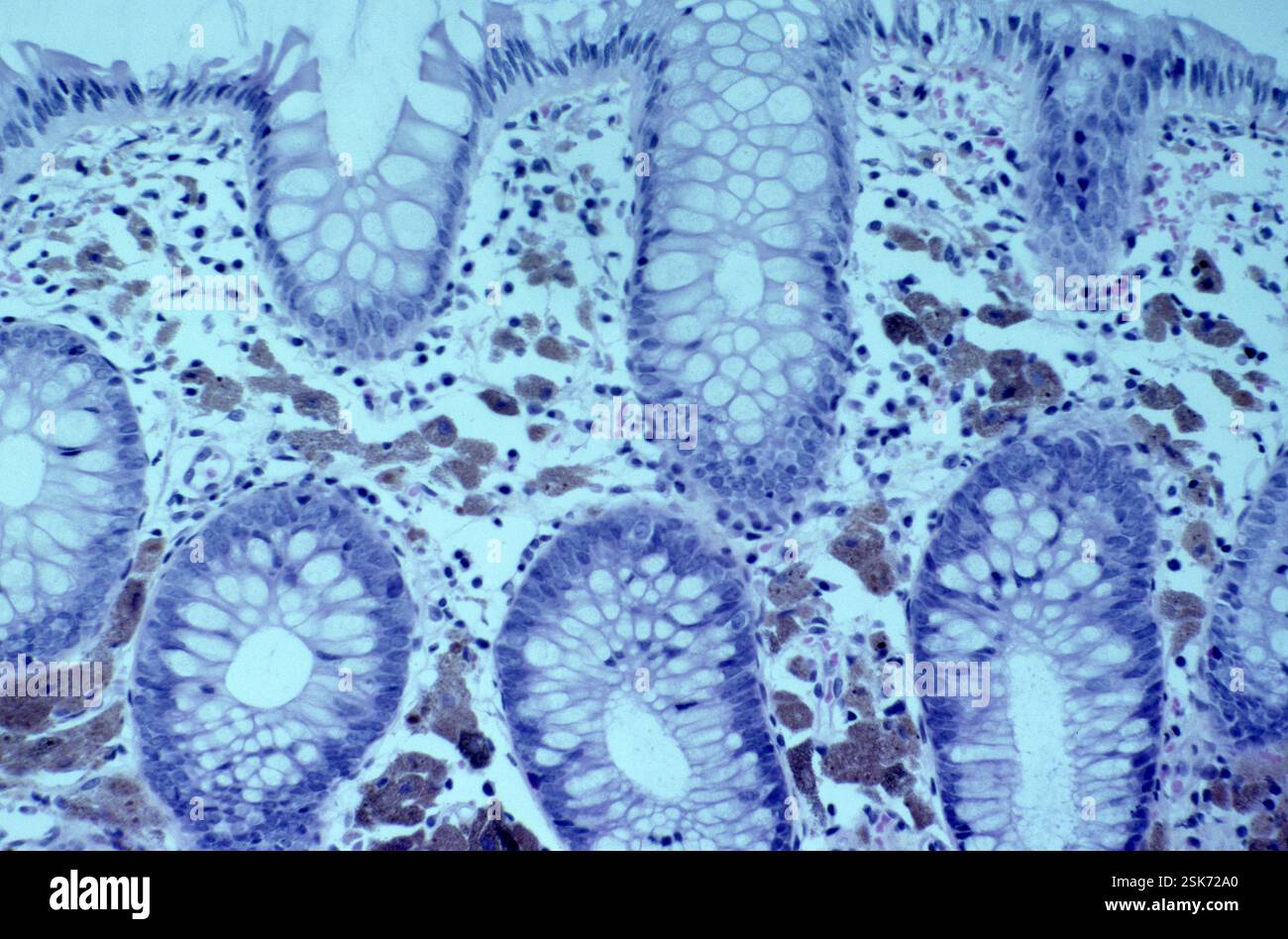 Autism, PET scan Stock Photo - Alamy