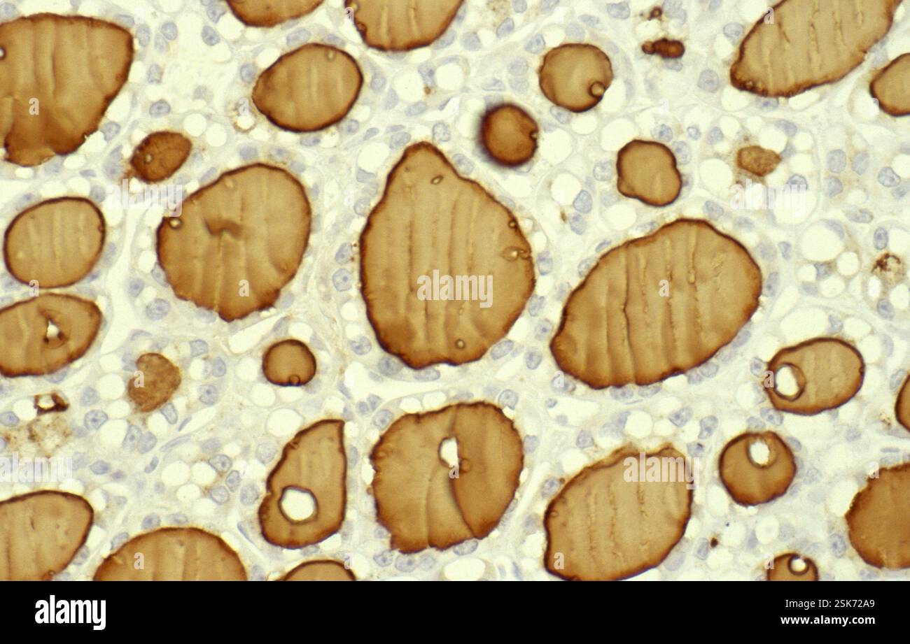 Light micrograph of a section of thyroid tissue affected by signet ring ...