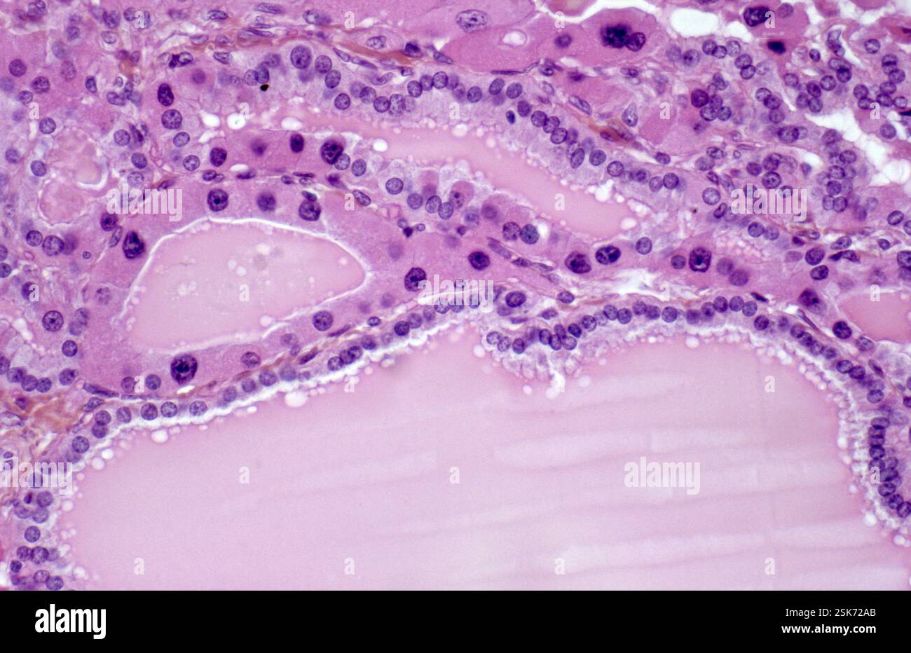 Light micrograph of a section of thyroid tissue affected by oncocytic ...