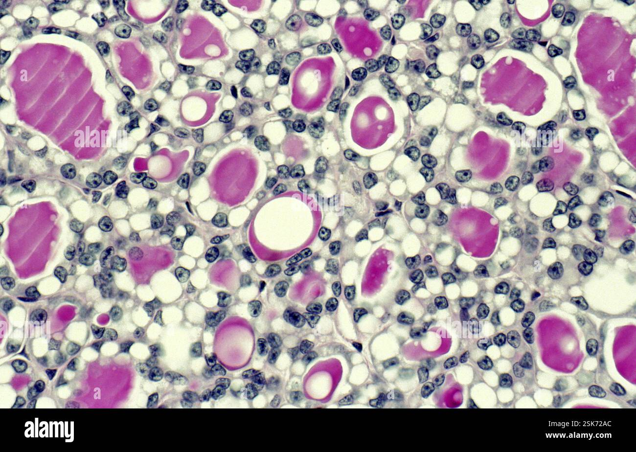 Light micrograph of a section of thyroid tissue affected by signet ring ...