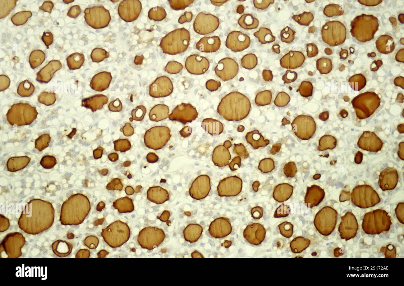Light micrograph of a section of thyroid tissue affected by signet ring ...