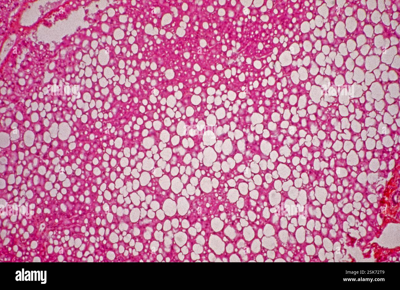 Light micrograph of a section of liver tissue affected by steatosis ...
