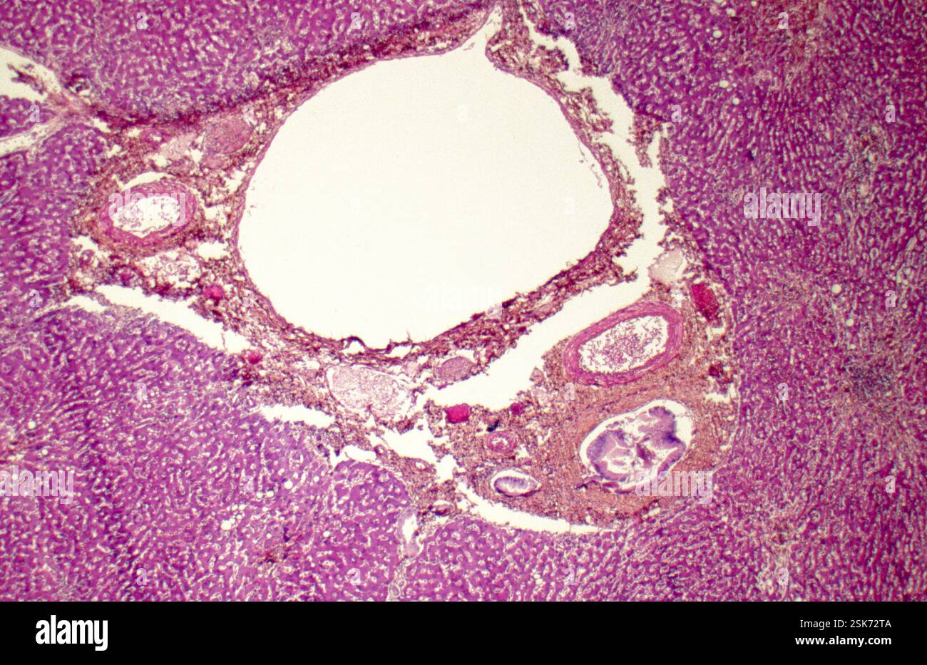 Toxoplasmosis, CT brain scan Stock Photo - Alamy