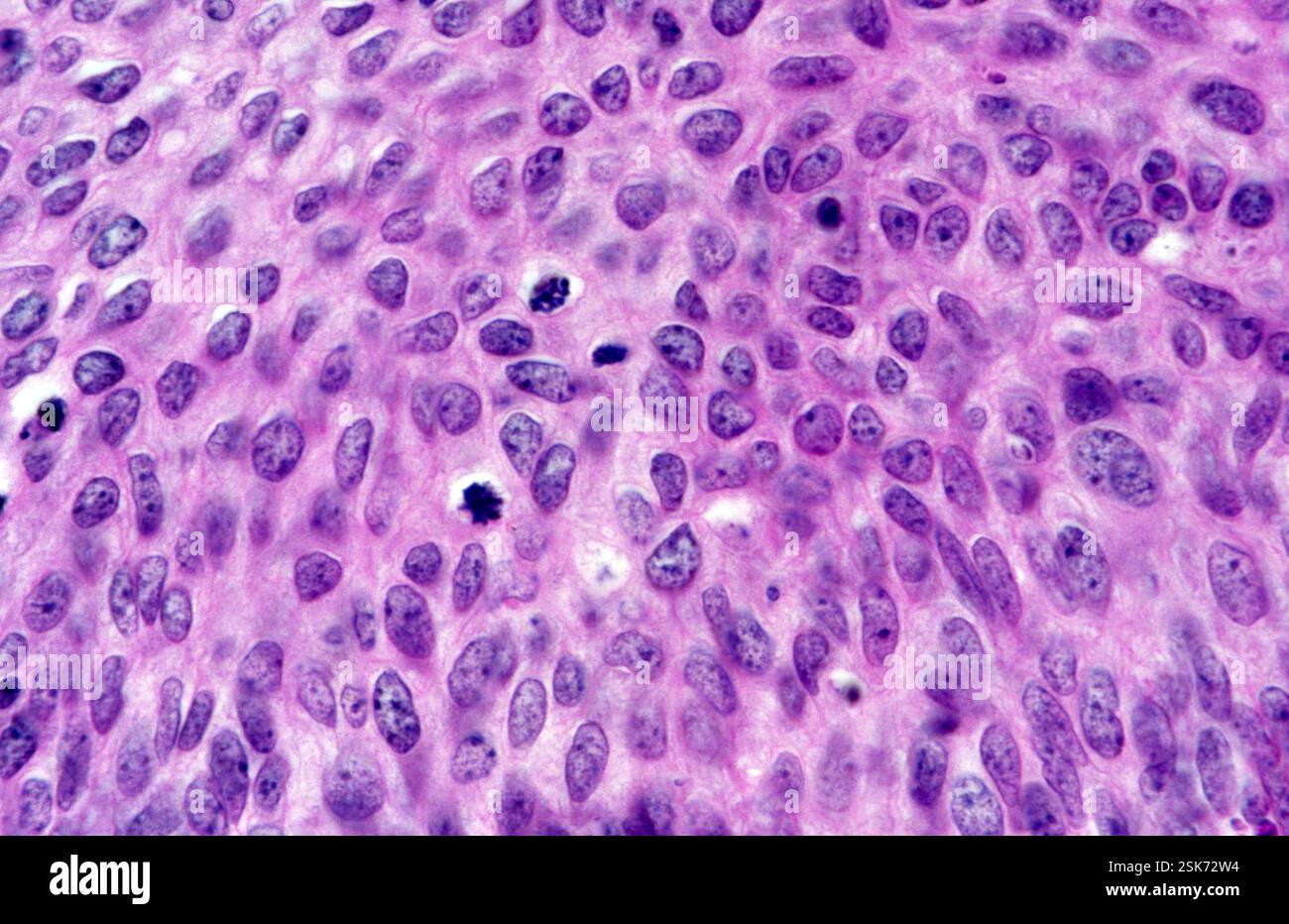 Light micrograph of a section of cervix that has been affected by ...