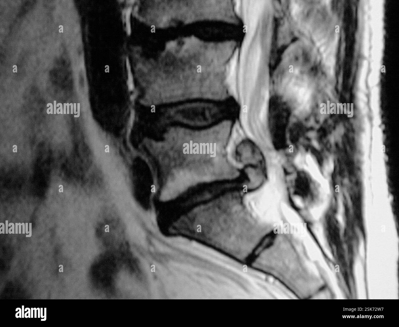 Sagittal magnetic resonance imaging (MRI) scan of the lower spine of a ...