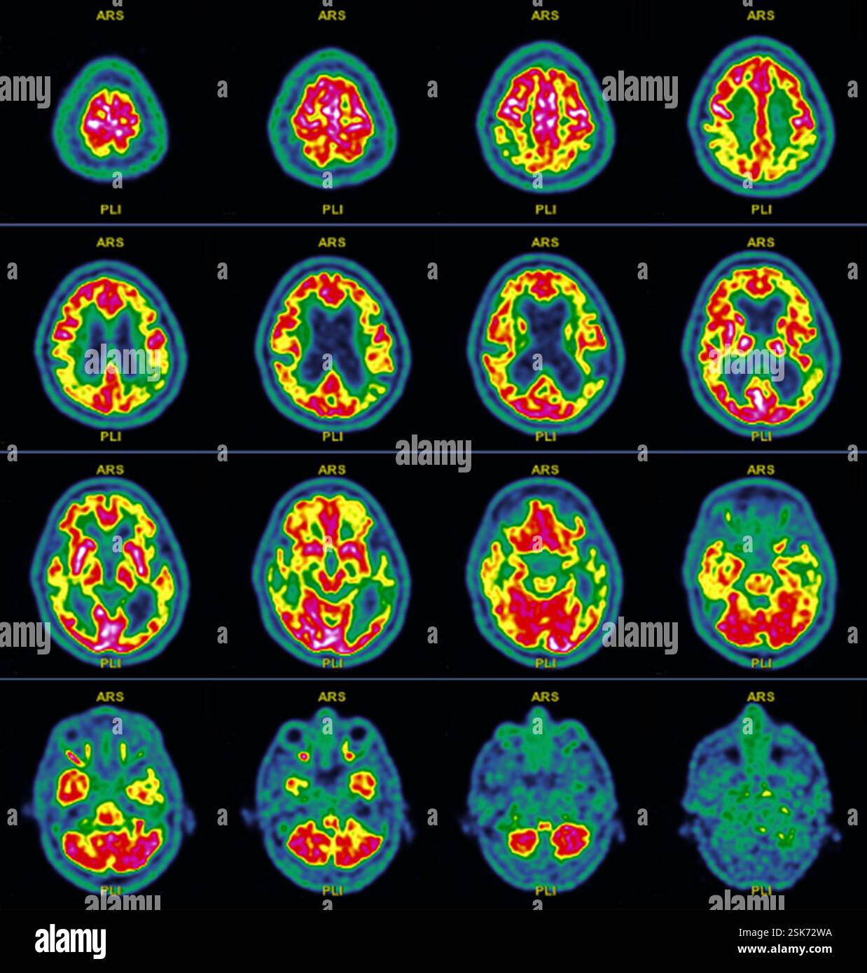 Coloured positron emission tomography (PET) scans of axial sections through the brain of a 60 ...