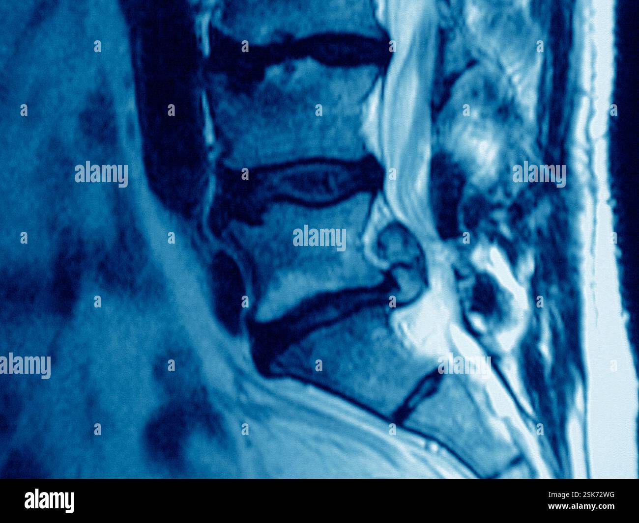 Coloured sagittal magnetic resonance imaging (MRI) scan of the lower ...