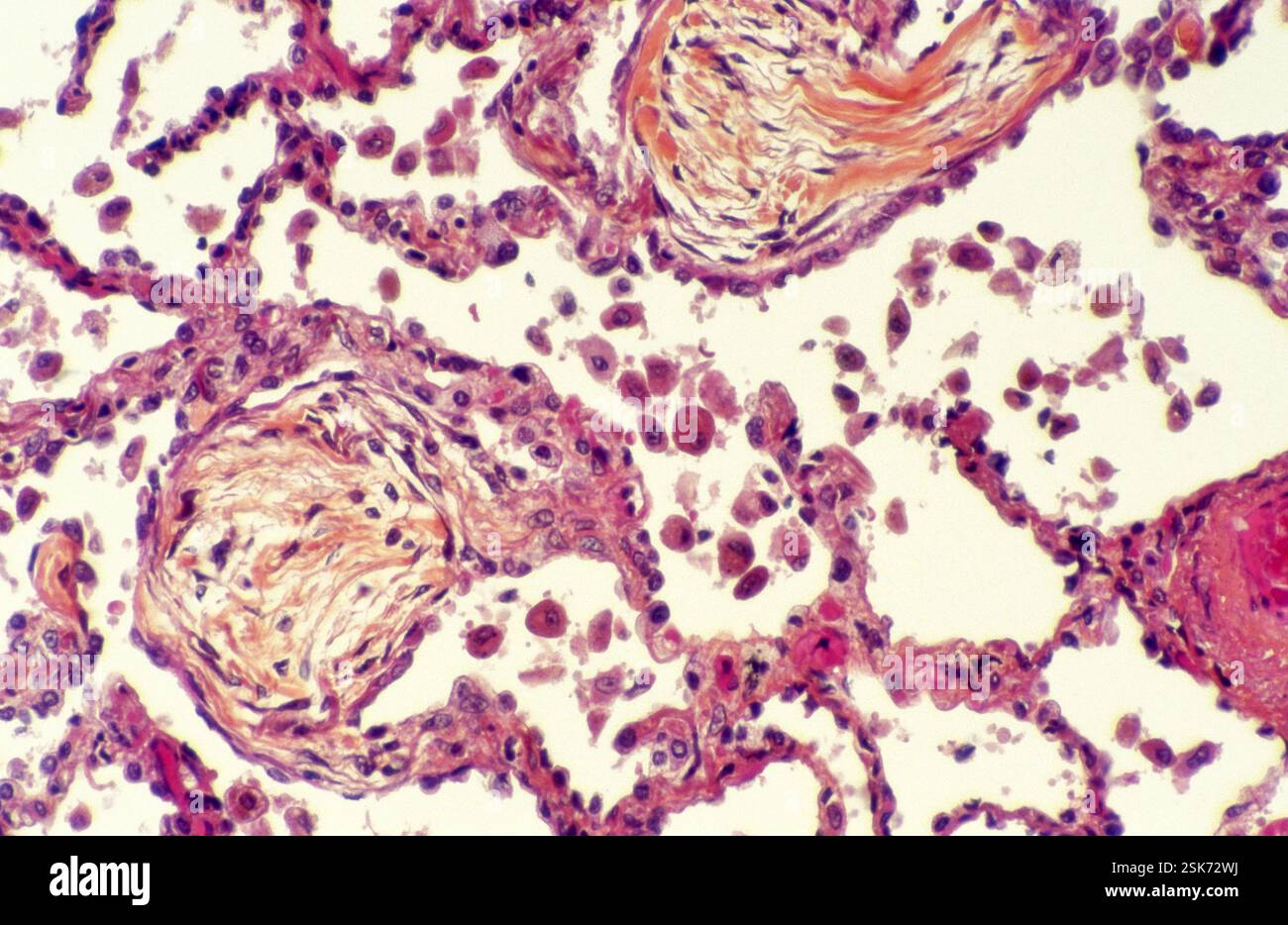 Light micrograph of a section of human lung affected by alveolitis ...