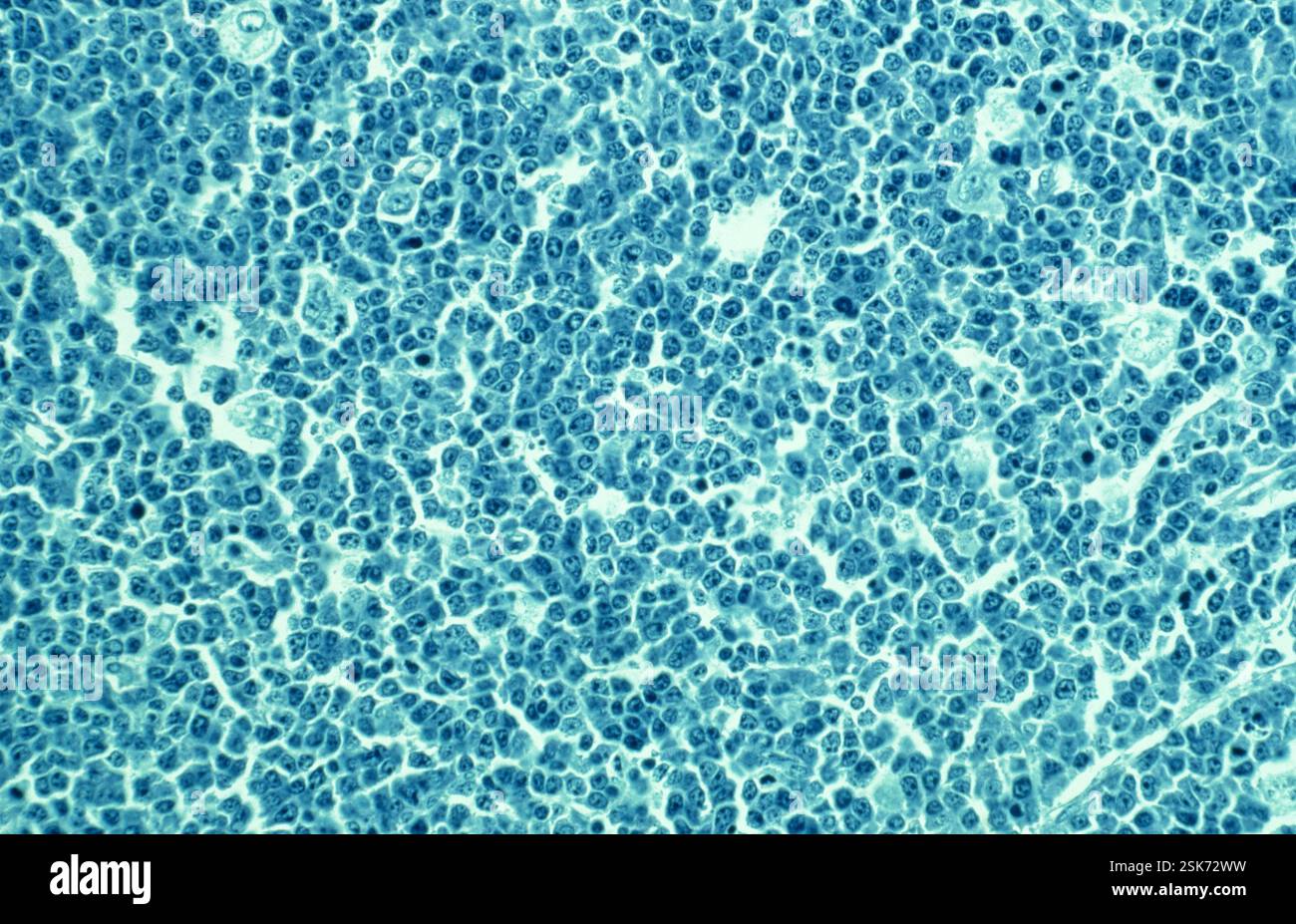 Light micrograph of diffuse large B-cell lymphoma (DLBCL) in a patient ...