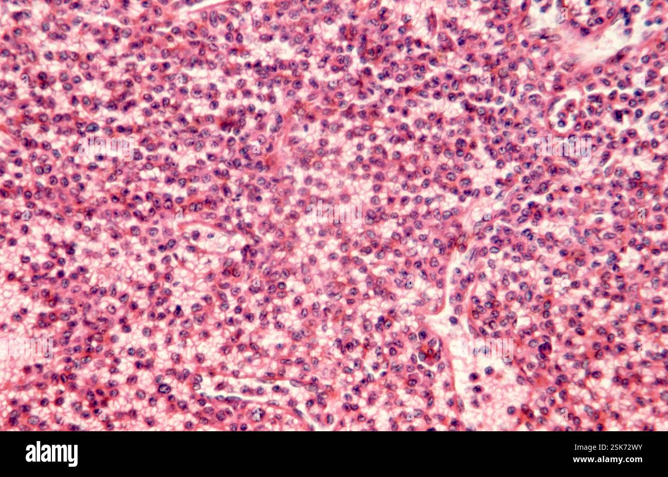 Secondary bone cancer, CT scan Stock Photo - Alamy