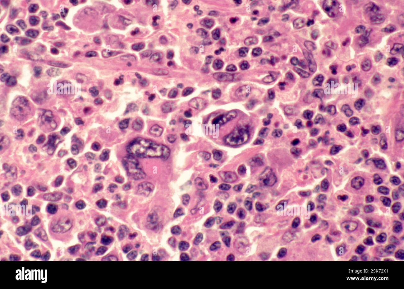 Light micrograph of Hodgkin's lymphoma in a patient's lymph node, shown ...