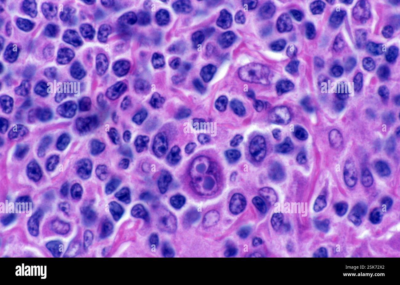 Light micrograph of Hodgkin's lymphoma in a patient's lymph node, shown ...
