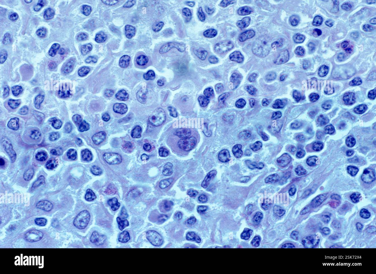 Light micrograph of Hodgkin's lymphoma in a patient's lymph node, shown ...
