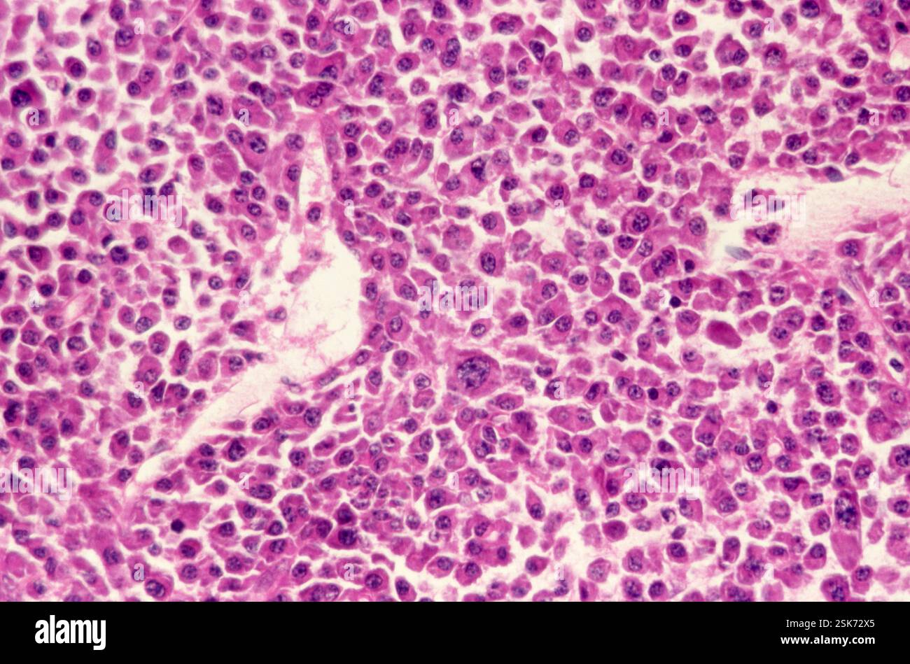 Light micrograph of bone marrow from a patient with reactive ...