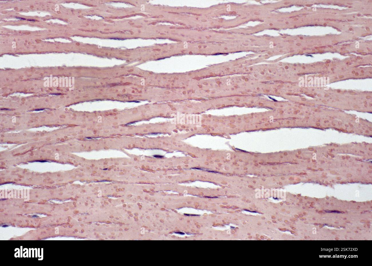 Secondary bone cancer, MRI scan Stock Photo - Alamy