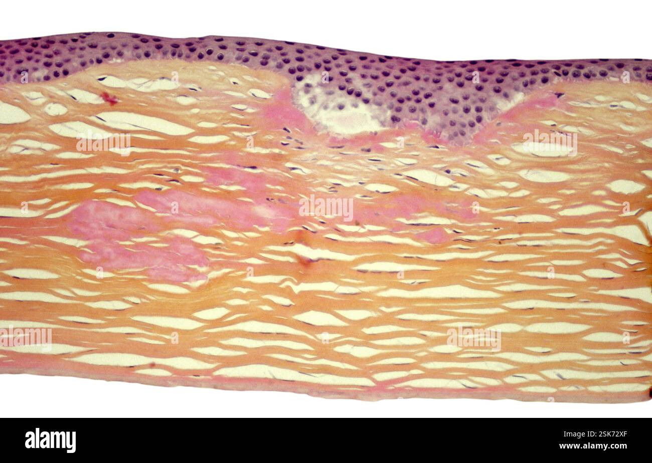 Light micrograph of the corneal stroma from a patient with granular ...