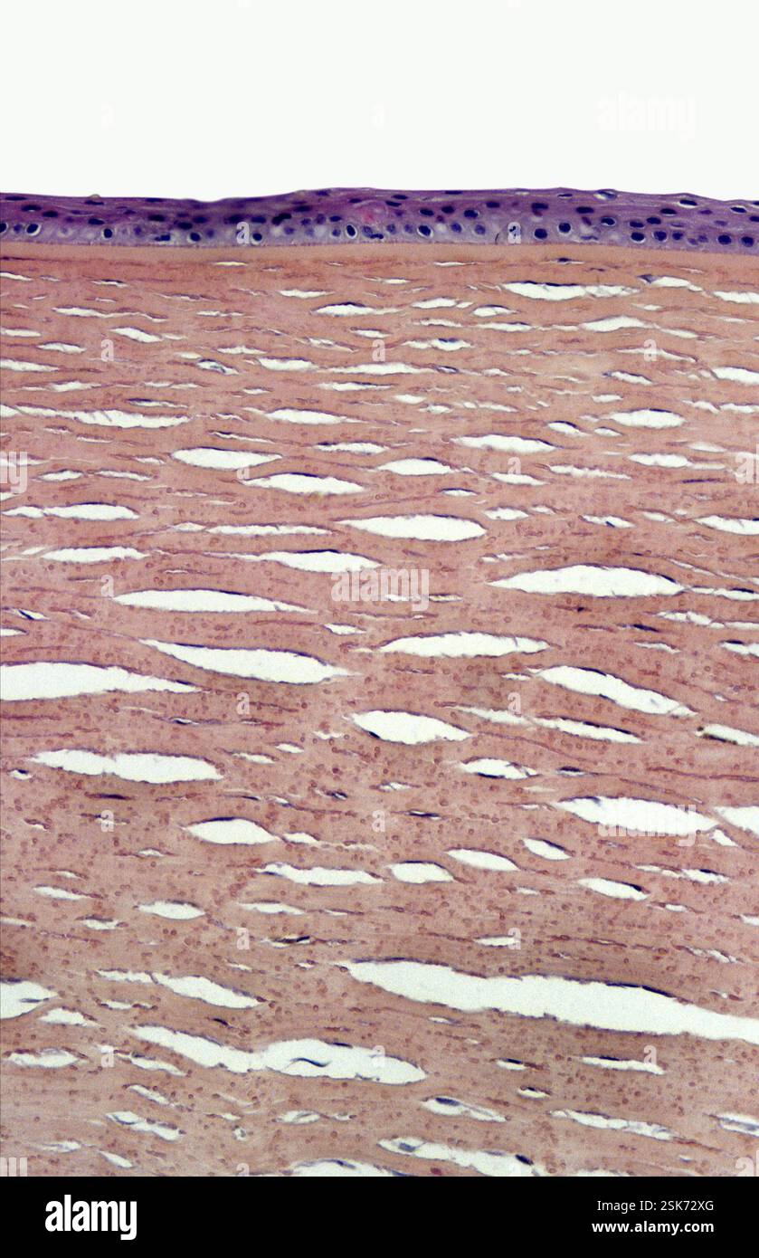 Secondary bone cancer, MRI scan Stock Photo - Alamy